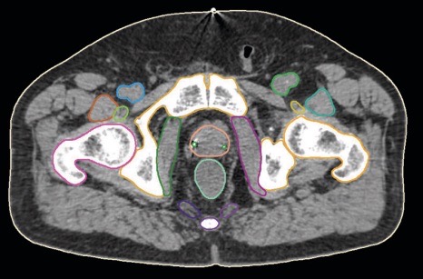 RT for Prostate Cancer: Faster and Better – Is it Possible? - MVision AI